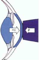 Tonómetro de Goldmann